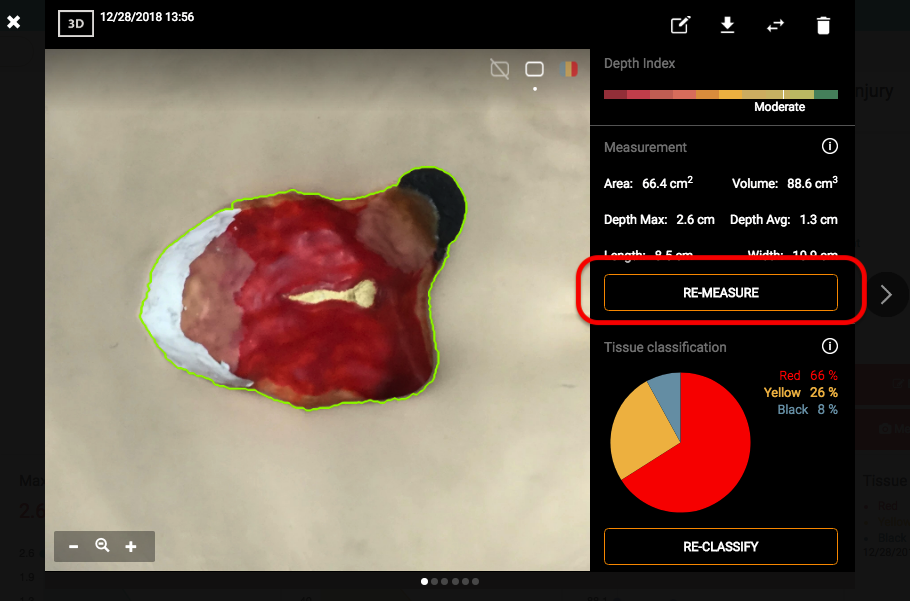 Redo Wound Measurement – eKare
