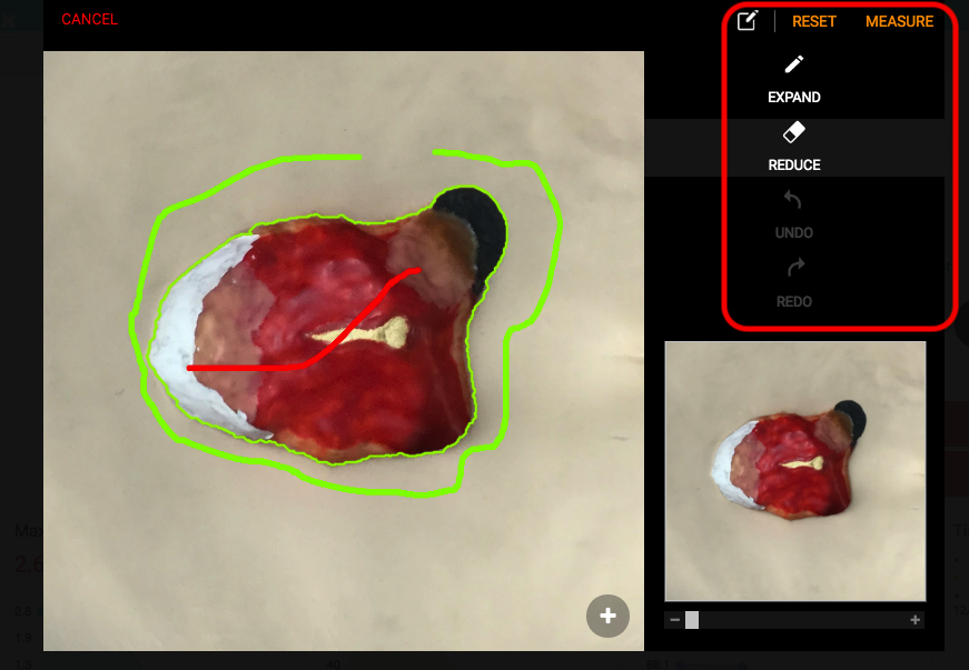 Redo Wound Measurement – eKare